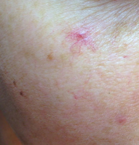 Angioma - Dr. Rocco Romano