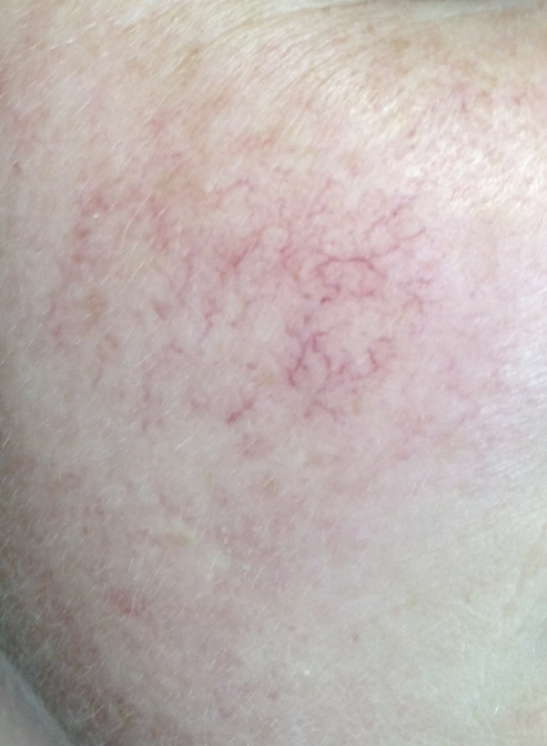 Couperose - Dr. Rocco Romano